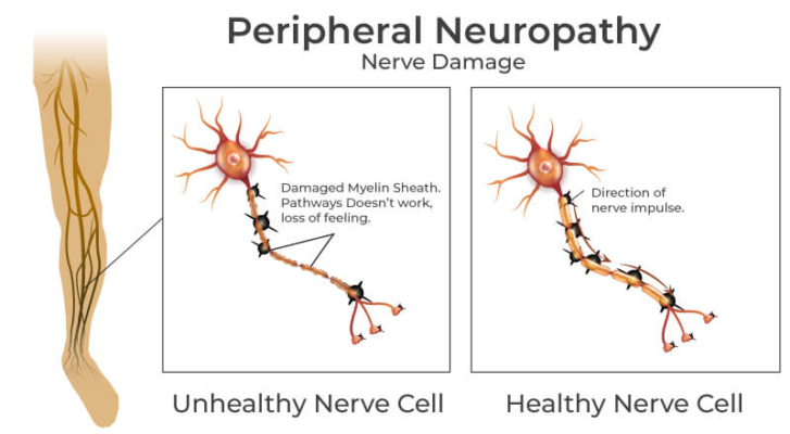 Peripheral Neuropathy Chiropractic Care | Chiro One